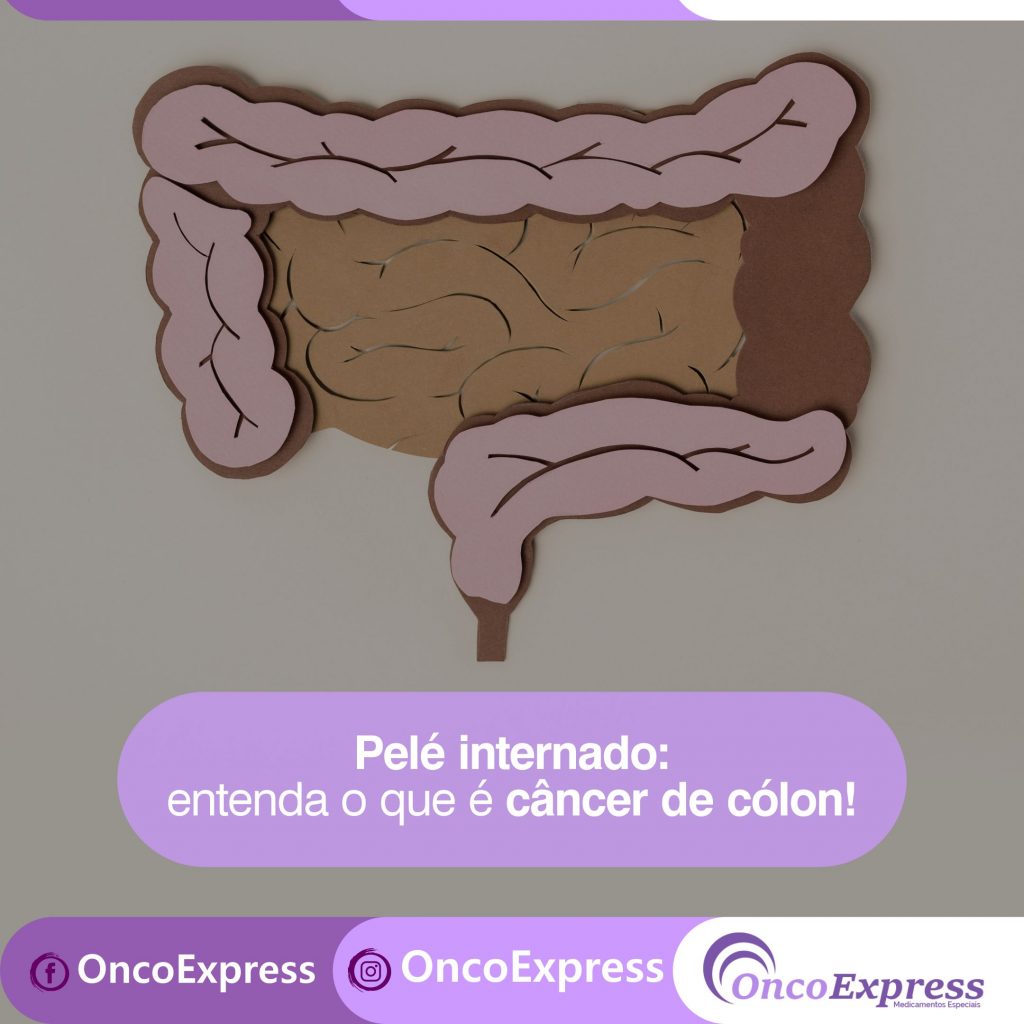 Pelé internado: entenda o que é câncer de cólon! - OncoExpress