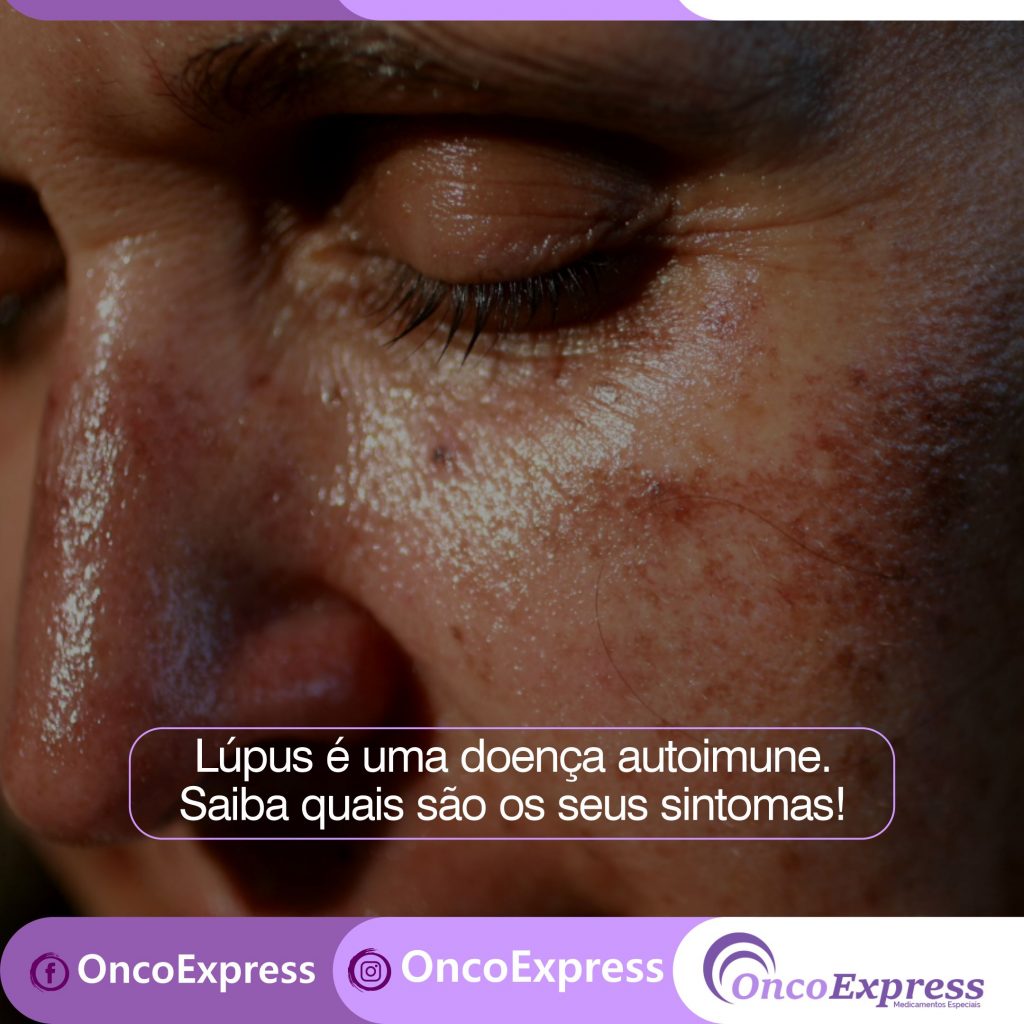 Lúpus é uma doença autoimune. Saiba quais são os seus sintomas ...
